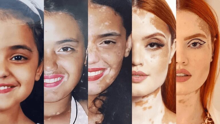 Vitiligo e Identidade Racial: A História de uma Influencer - PODER AO POVO